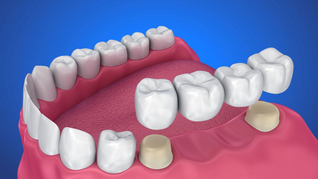 Can a Dental Bridge Be Removed and Recemented Safely?
