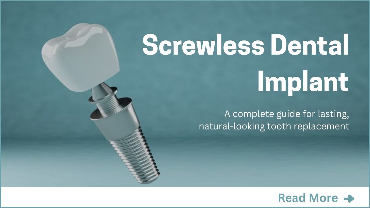 What Is Screwless Dental Implant?